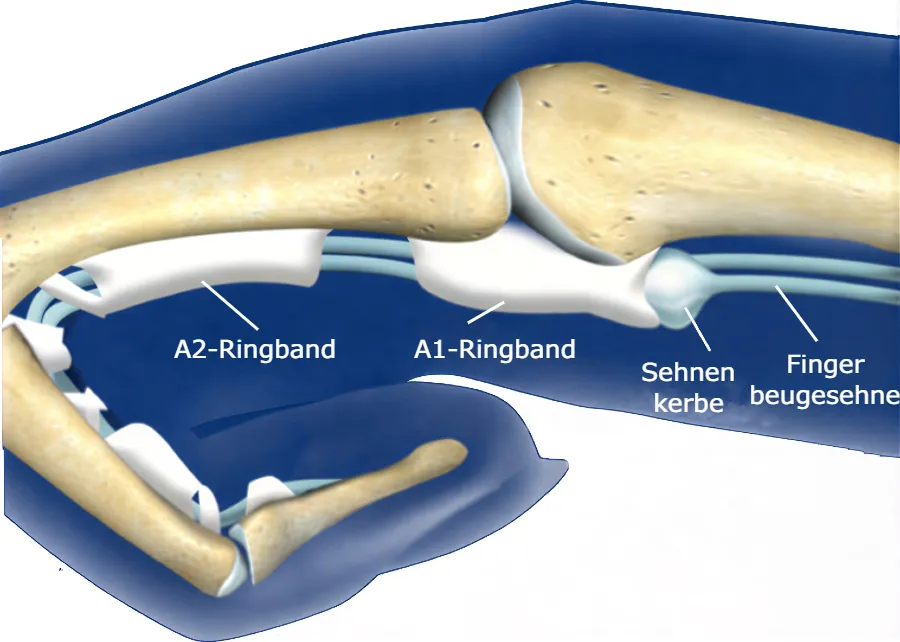 Schnappfinger (Tendovaginitis stenosans): Ursachen und Behandlung ...